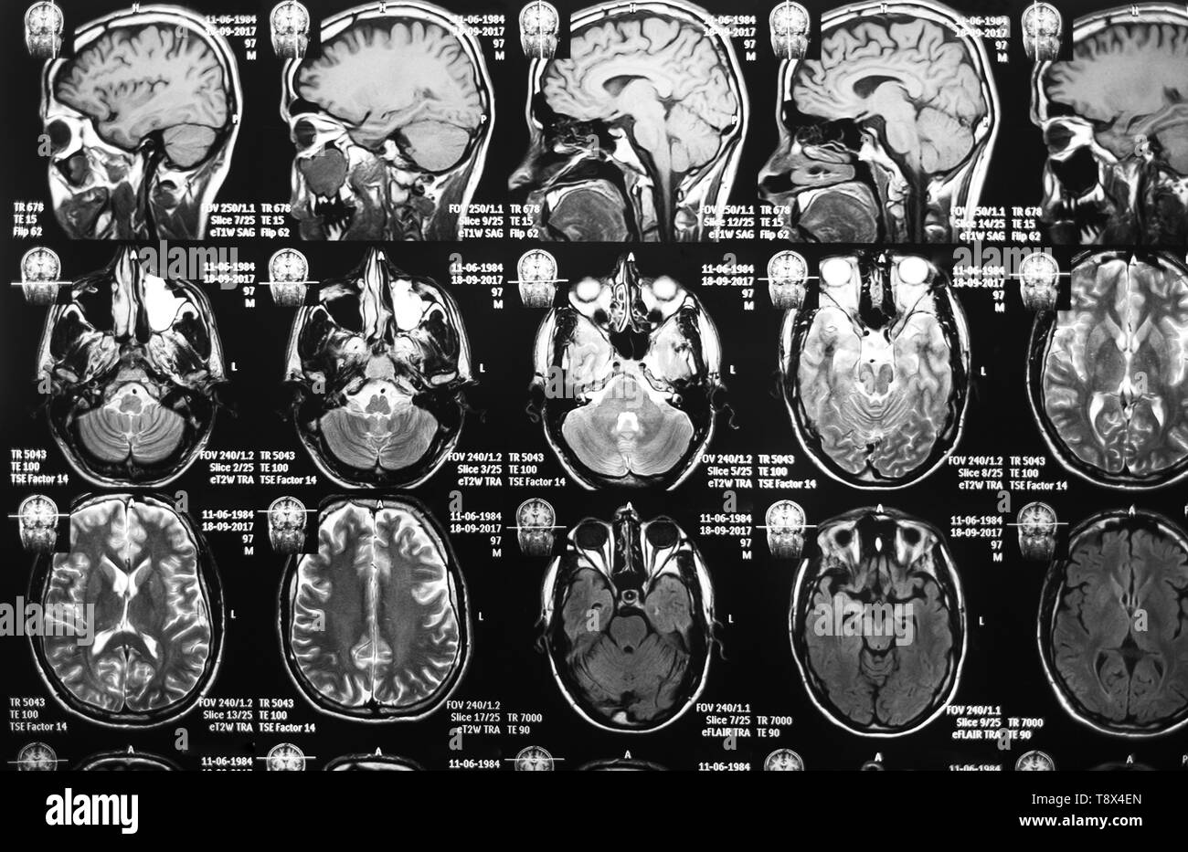 Resonancia Magnética De La Anatomía Del Cerebro