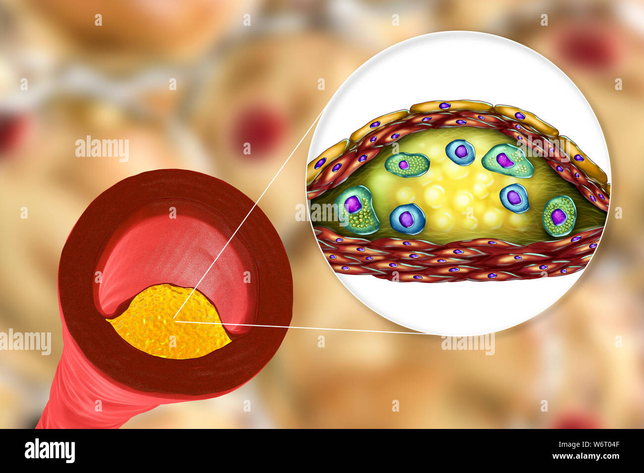 Muestra De Placa De Aterosclerosis
