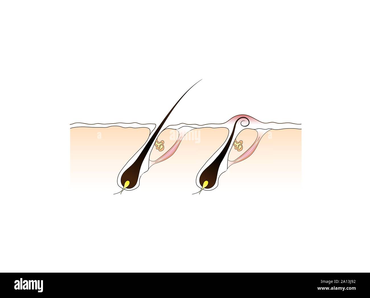 La croissance des cheveux. Un poil incarné une inflammation de la peau ...
