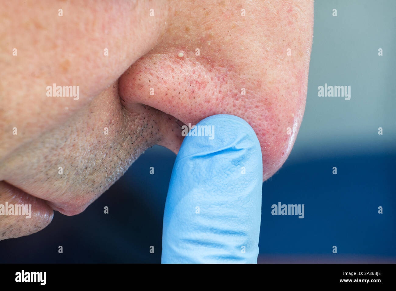 Close up man face avec whitehead boutons sur le nez, la maladie de l ...