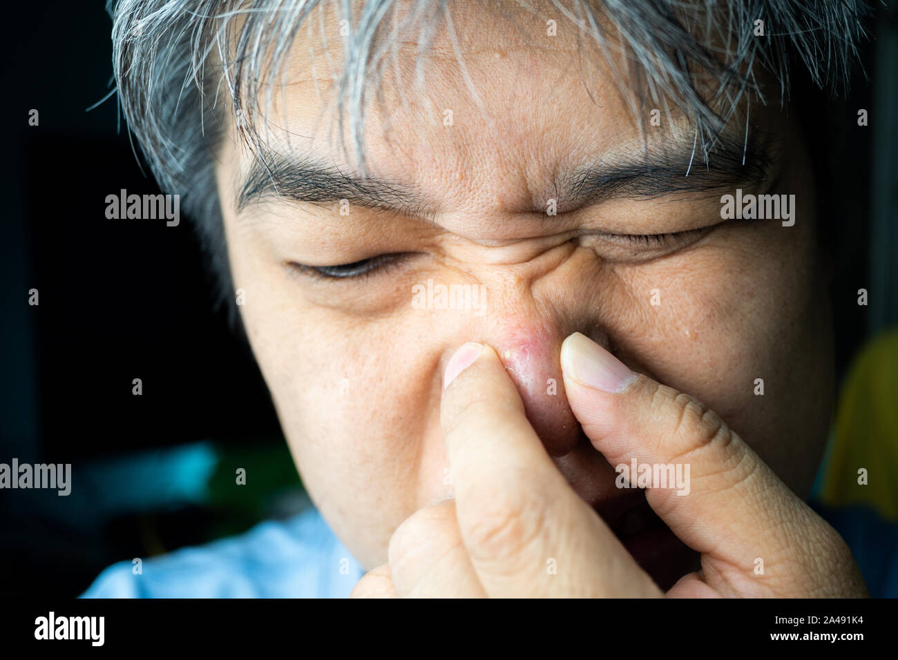 Pimple on nose Banque de photographies et d’images à haute résolution ...
