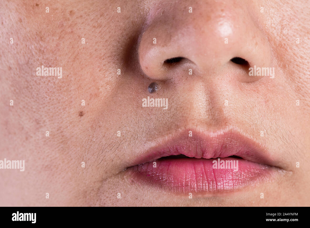 Pigmentation Taches Peau Banque d'image et photos - Alamy