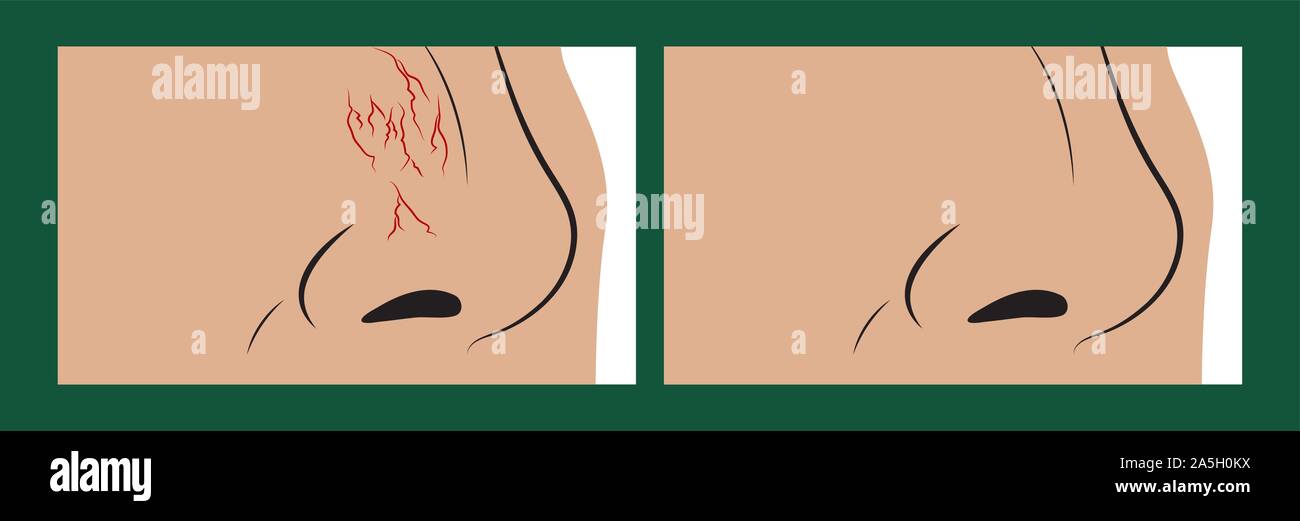 Maladie vasculaire Banque d'images vectorielles - Alamy