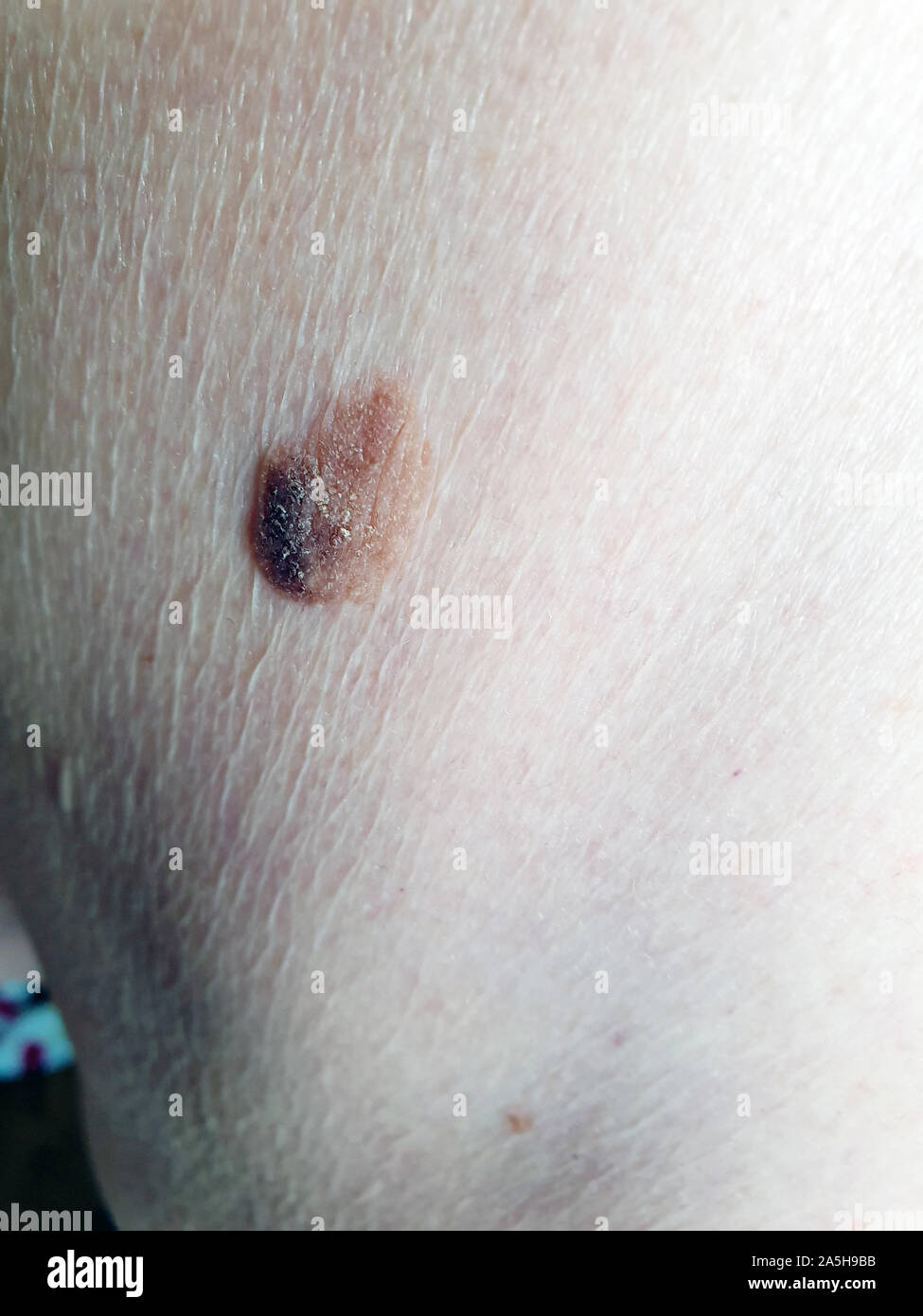 Verrue séborrhéique Banque de photographies et d’images à haute ...