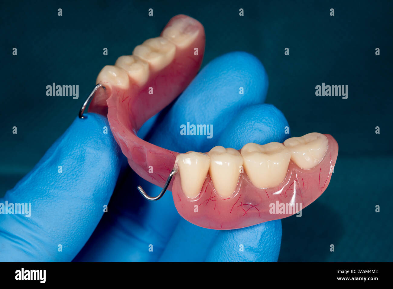 Prothèse dentaire. Prothèse amovible partielle de la mâchoire ...