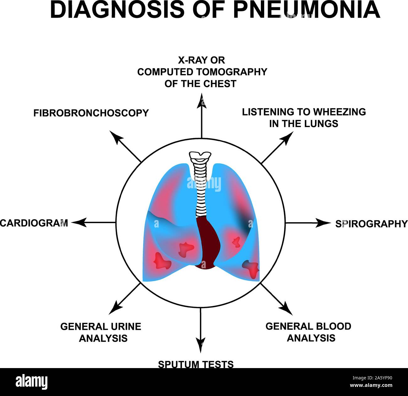 Diagnostic de la pneumonie. Les organes respiratoires. La Journée ...