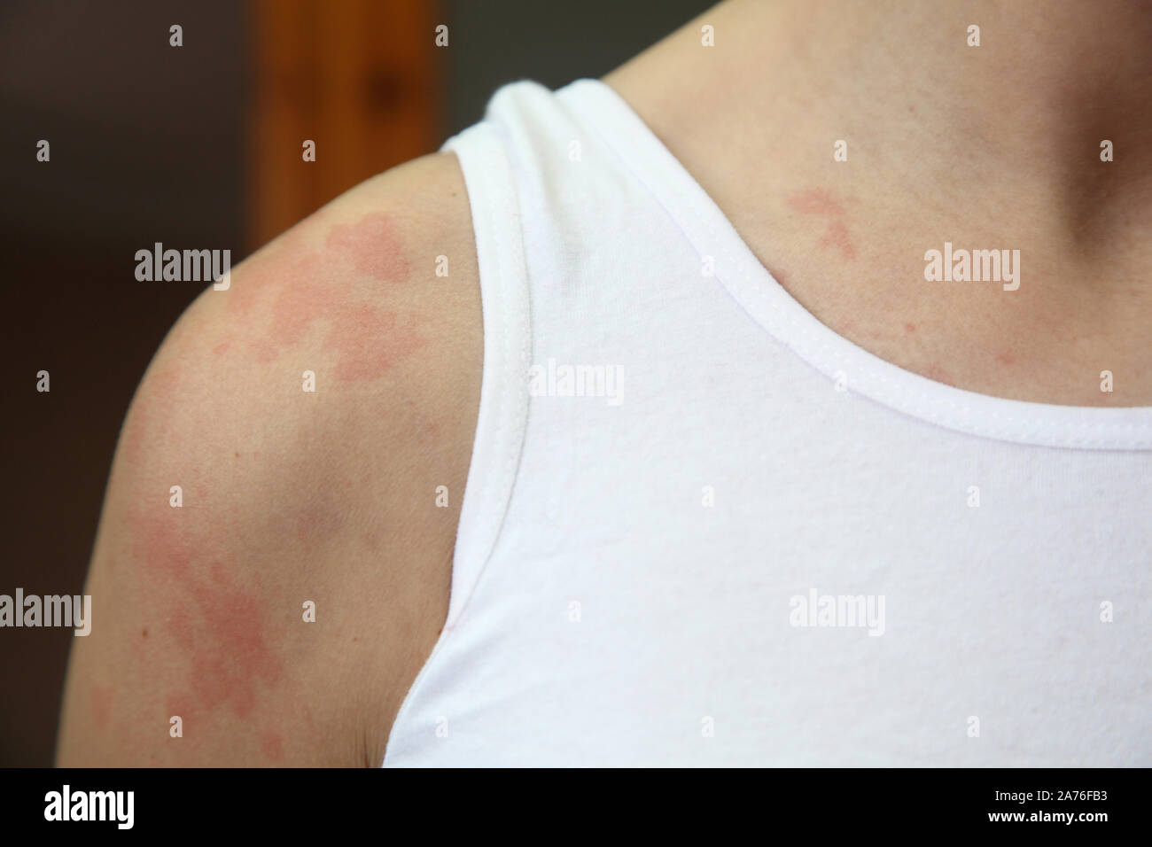 Allergie de la peau Banque de photographies et d’images à haute ...