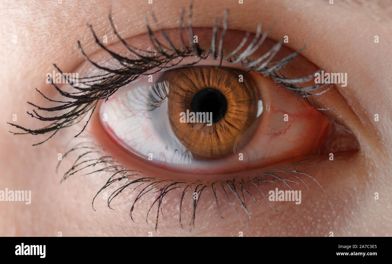 Conjunctivitis veins Banque de photographies et d’images à haute ...