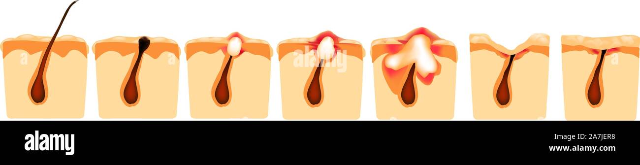 Comédon fermé Banque d'images détourées - Alamy