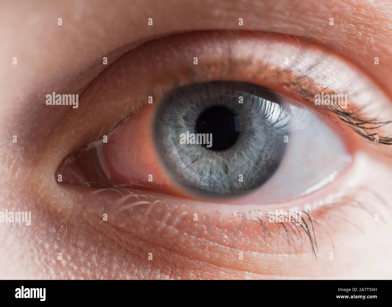 Conjunctivitis veins Banque de photographies et d’images à haute ...