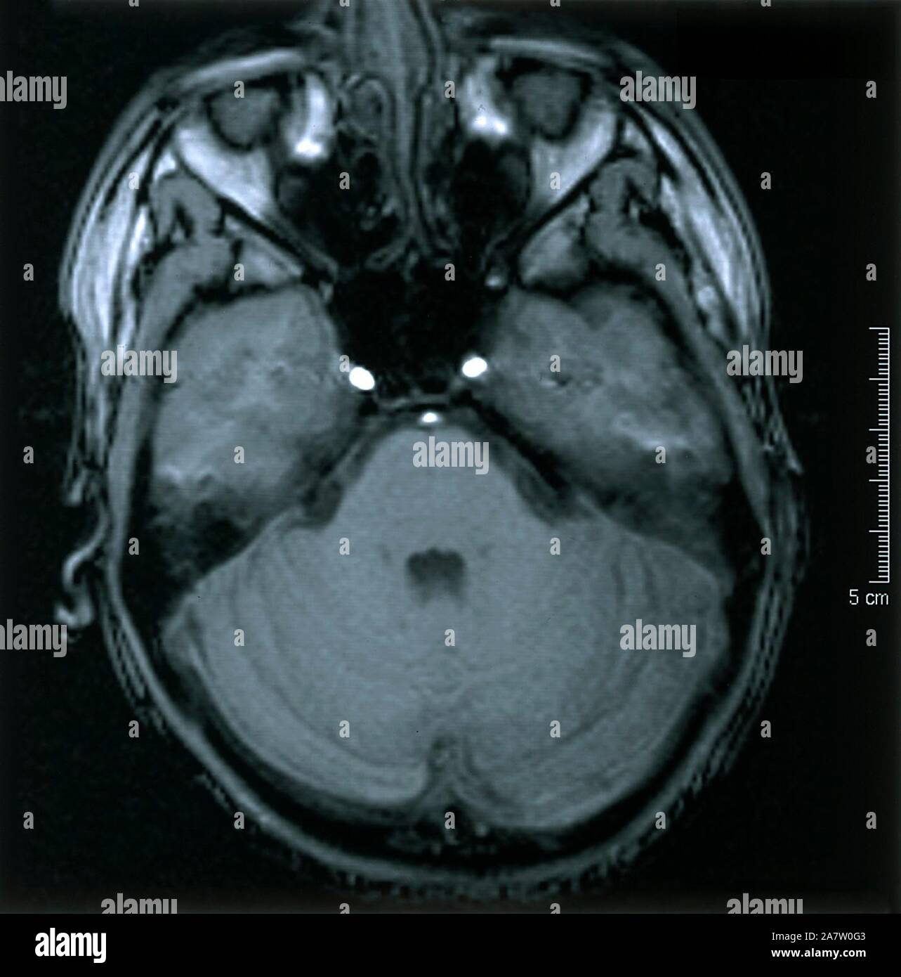 Irm cervelet axial Banque de photographies et d’images à haute ...