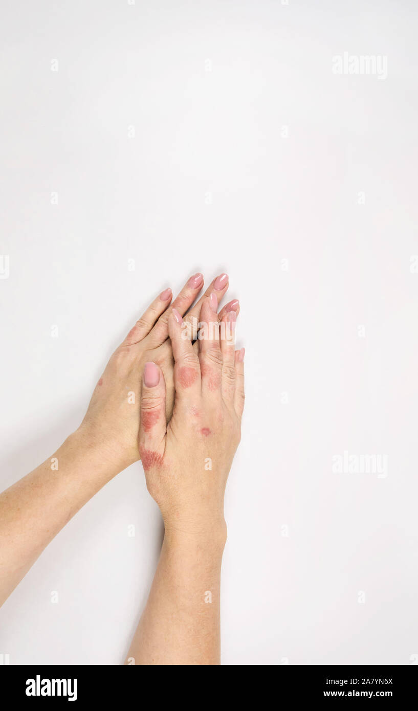 Skin rash eczema on hands Banque de photographies et d’images à haute ...