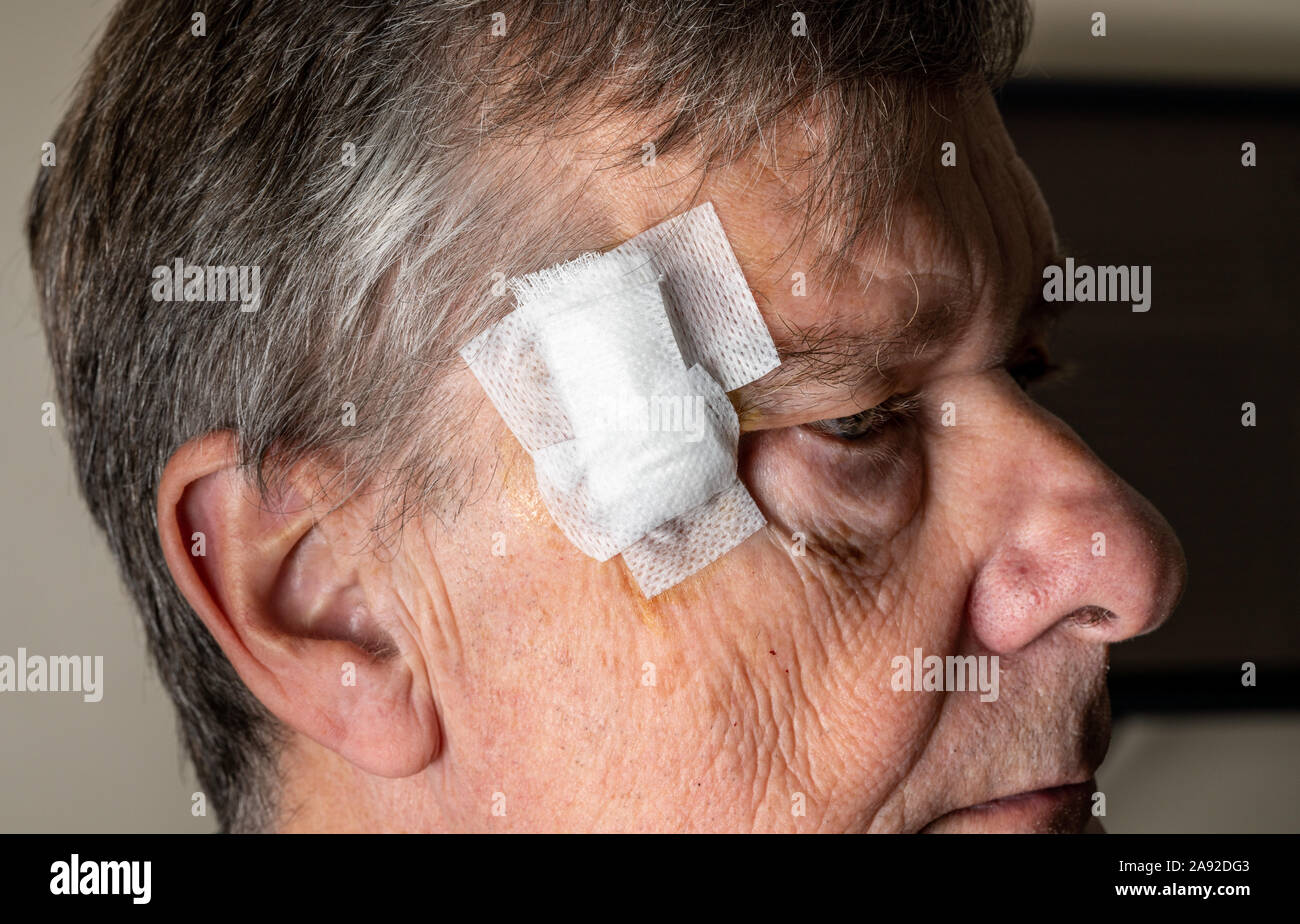 Carcinome basocellulaire Banque de photographies et d’images à haute ...