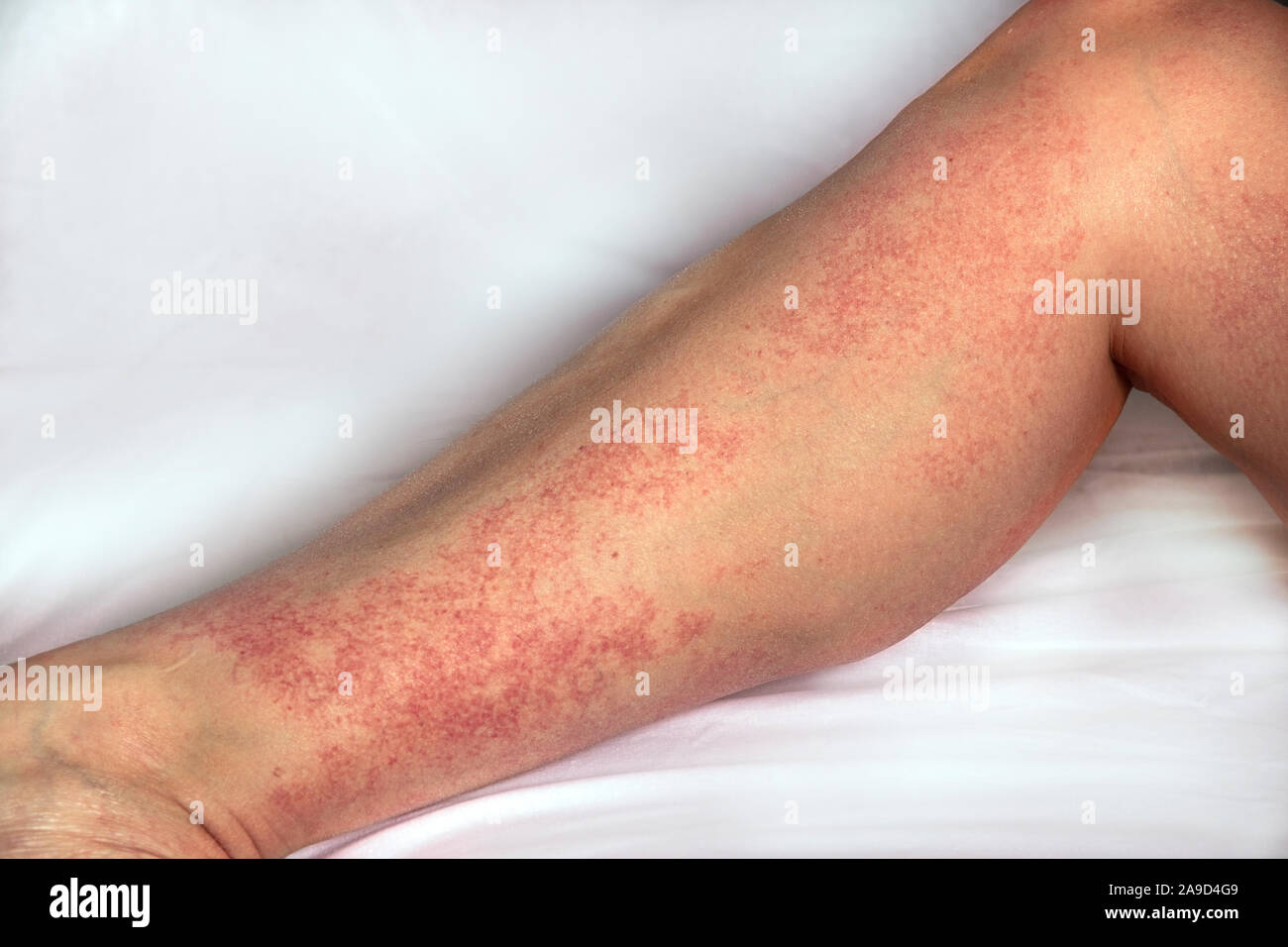 De fortes éruptions allergiques sur la jambe. Déficit immunitaire et de ...