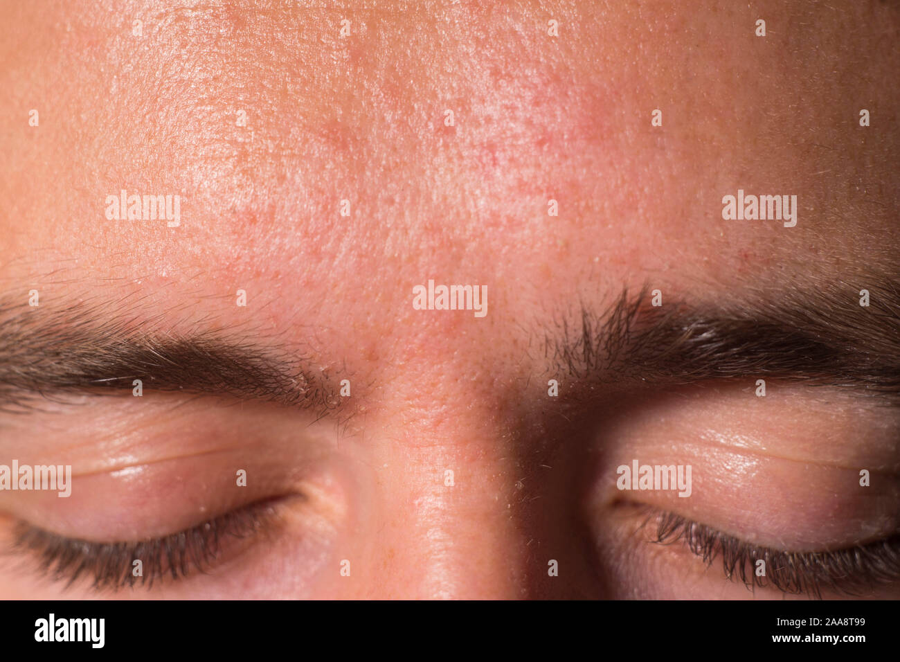 Dyshidrotic eczema Banque de photographies et d’images à haute ...