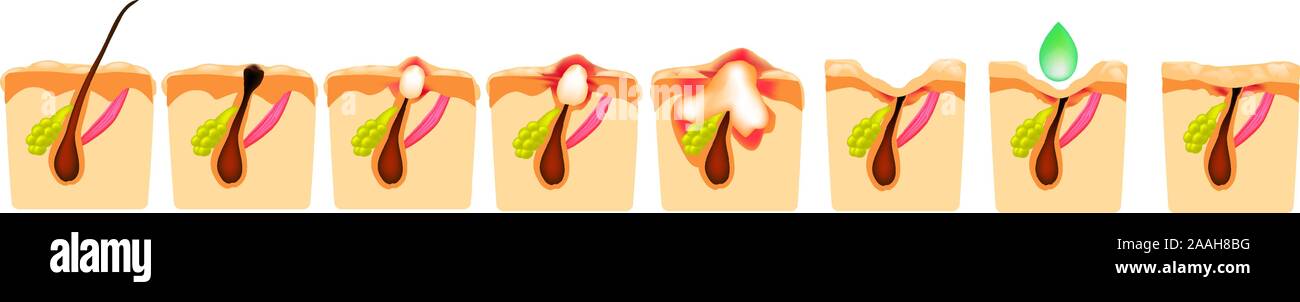 Traitement des comédons ouverts, à l'inflammation de l'acné, kystes d ...