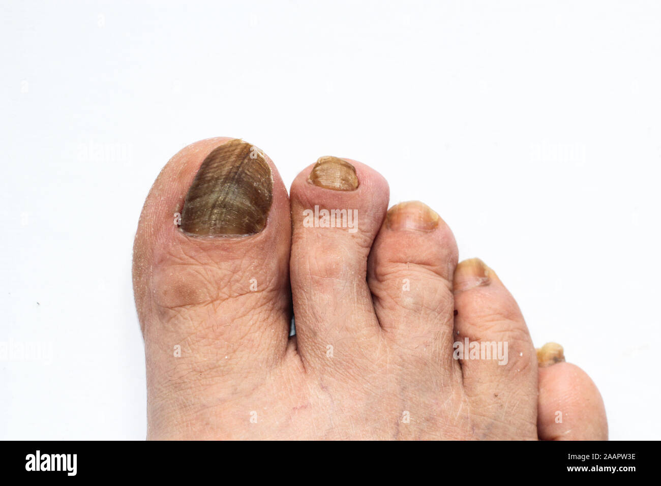 Maladie du pied champigion Banque de photographies et d’images à haute ...