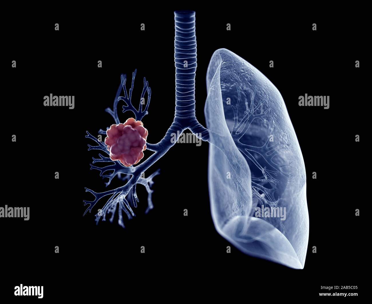 Tumeur du poumon Banque de photographies et d’images à haute résolution ...