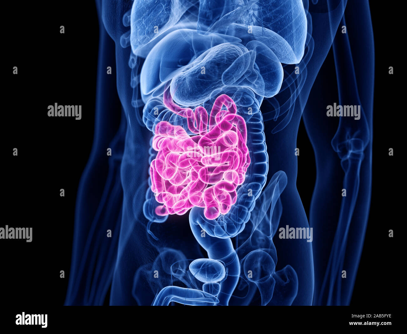 Une occlusion intestinale Banque de photographies et d’images à haute ...