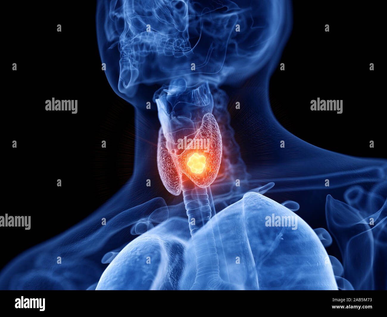Thyroide cancer Banque de photographies et d’images à haute résolution ...