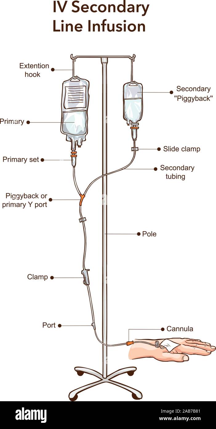 IV perfusion ligne secondaire vector illustration Image Vectorielle ...