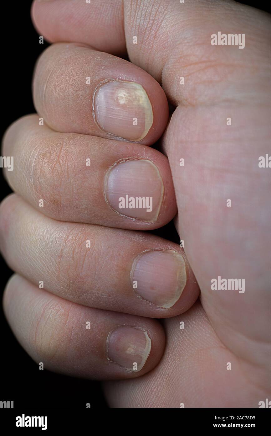 Maladie cutanée Banque de photographies et d’images à haute résolution ...