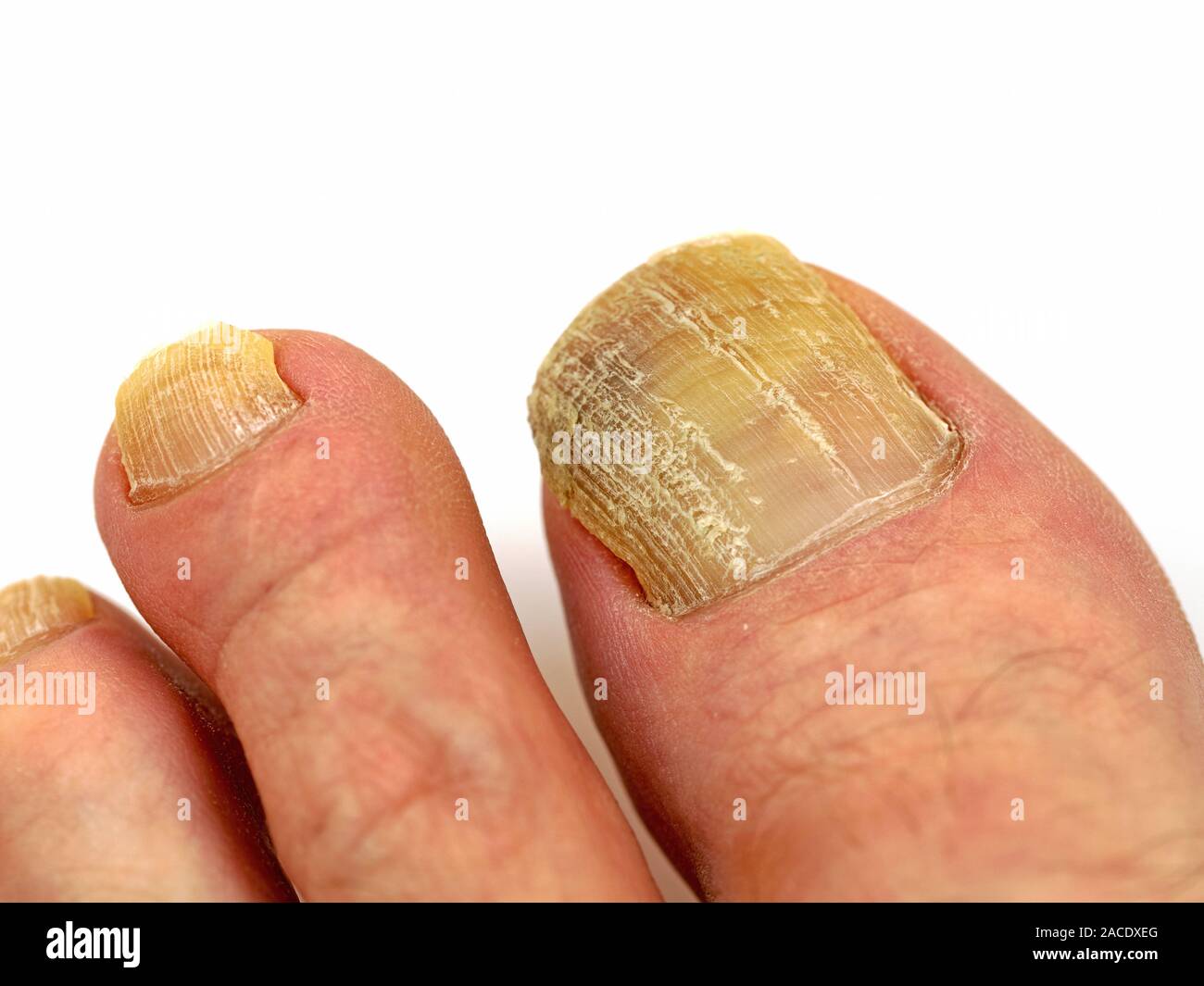 Mycose des ongles Banque de photographies et d’images à haute ...