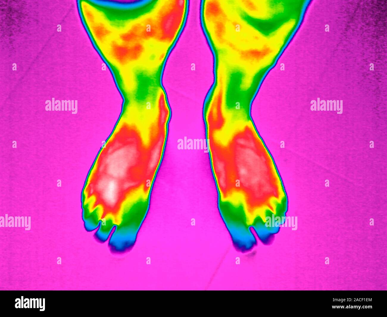 Thermogramme, pieds. Un thermogramme montre la variation de la ...