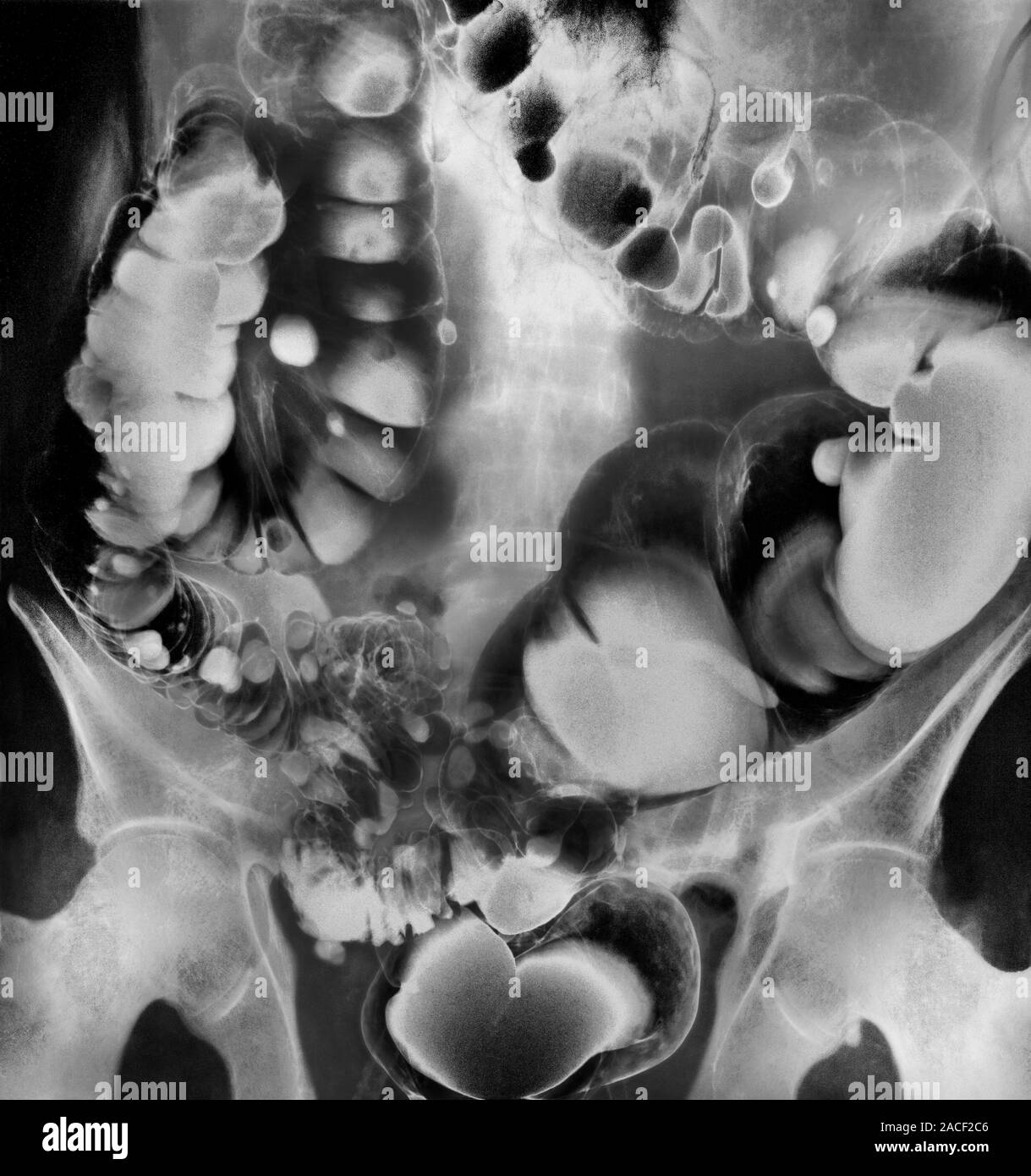 La maladie diverticulaire. Le lavement baryté contraste X-ray du gros ...