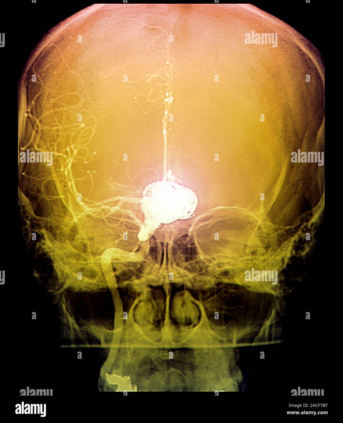 Traitement de l'anévrisme. Angiogramme de couleur du traitement d'un ...