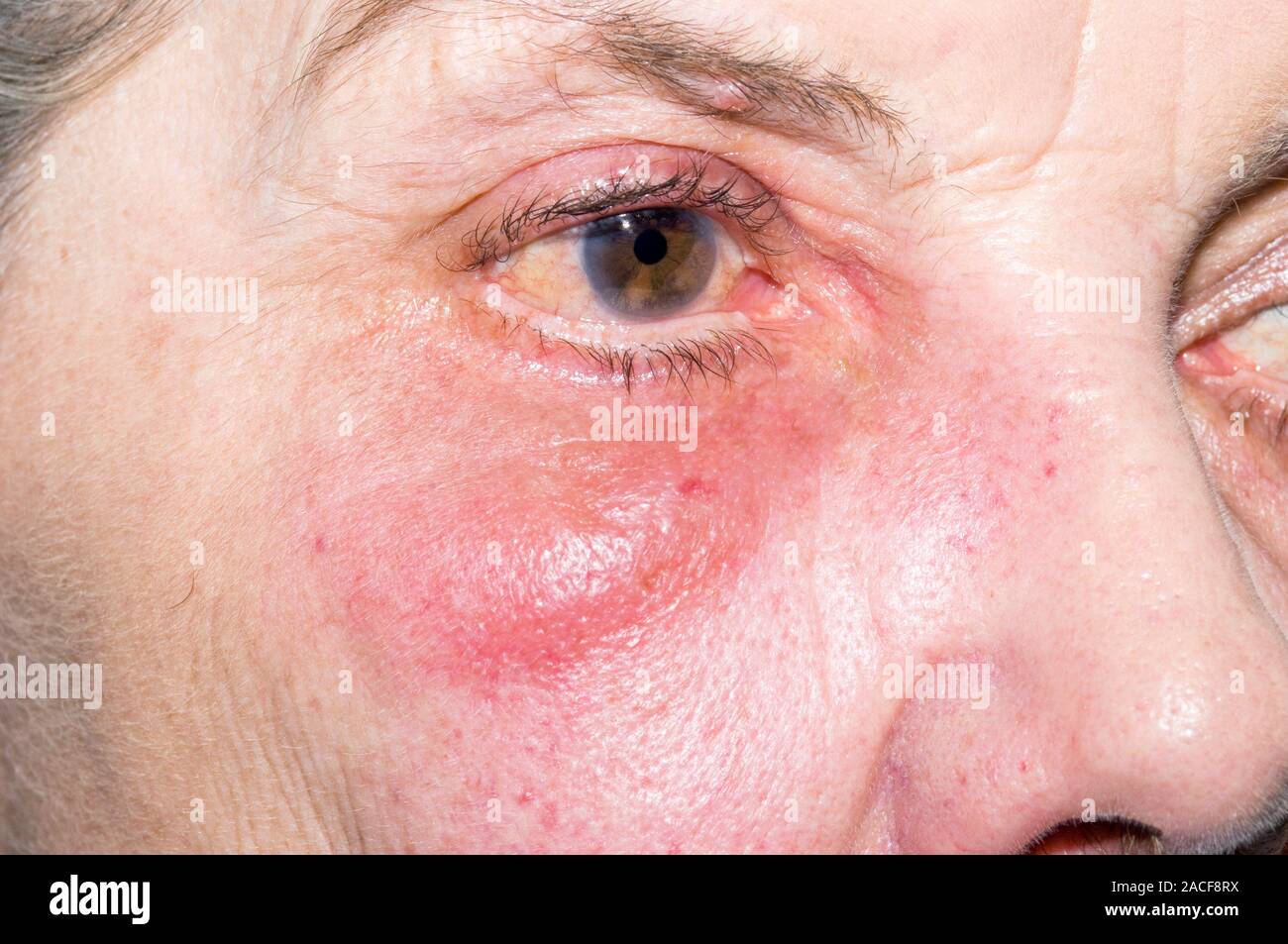 Piqûres d'allergie. Réaction allergique à une piqûre d'insecte sur un ...