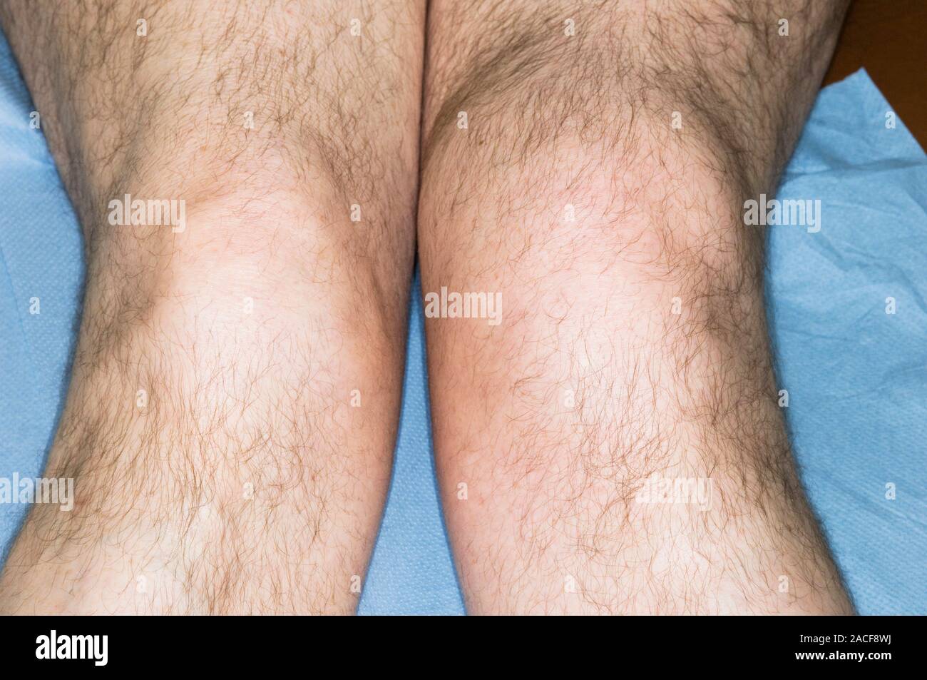 Genou enflé (droite) dans un homme de 63 ans. C'est un gonflement aigu ...