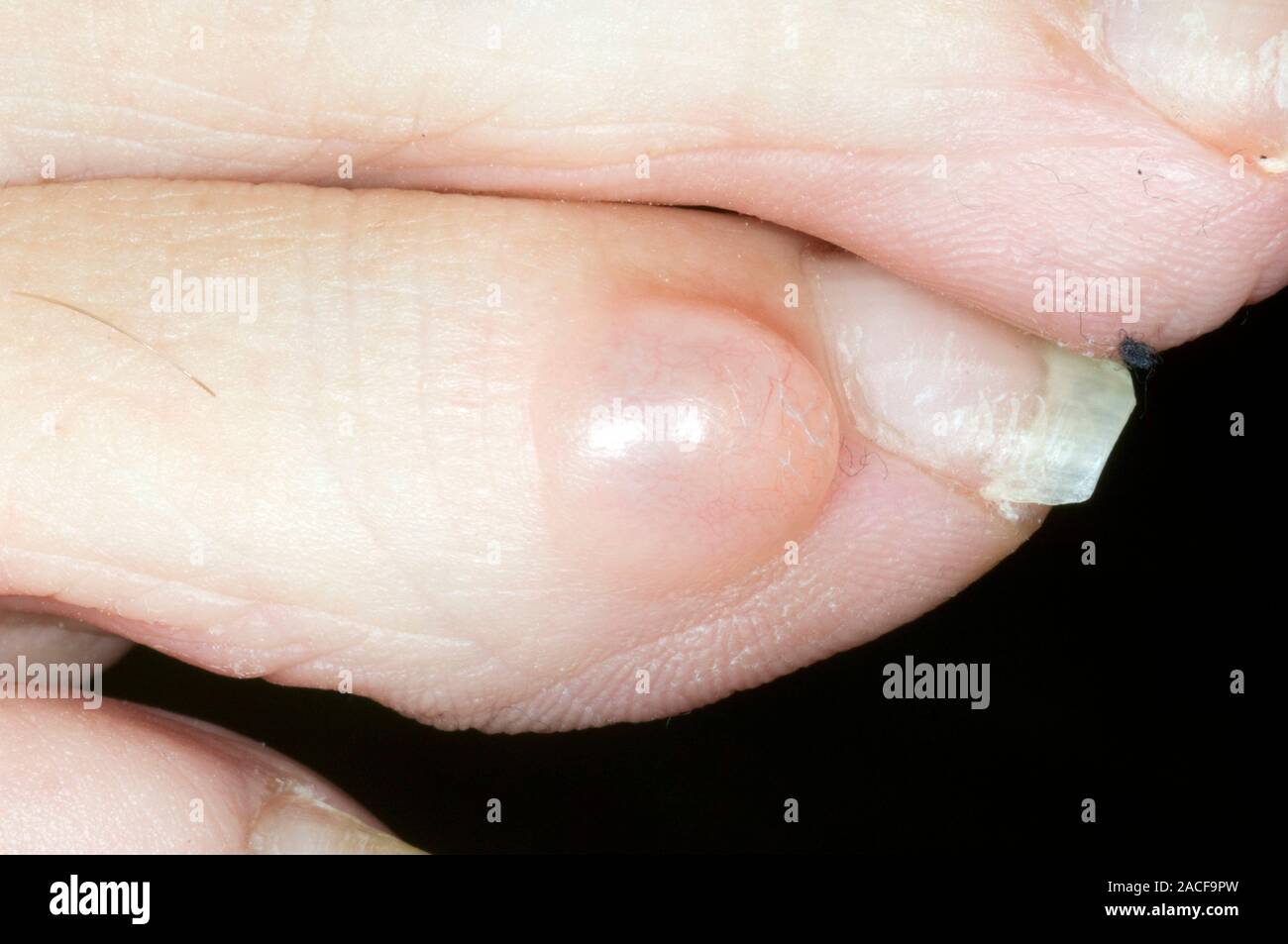Kyste synovial. Image 1 de 2. Kyste synovial sur l'orteil d'un homme de ...