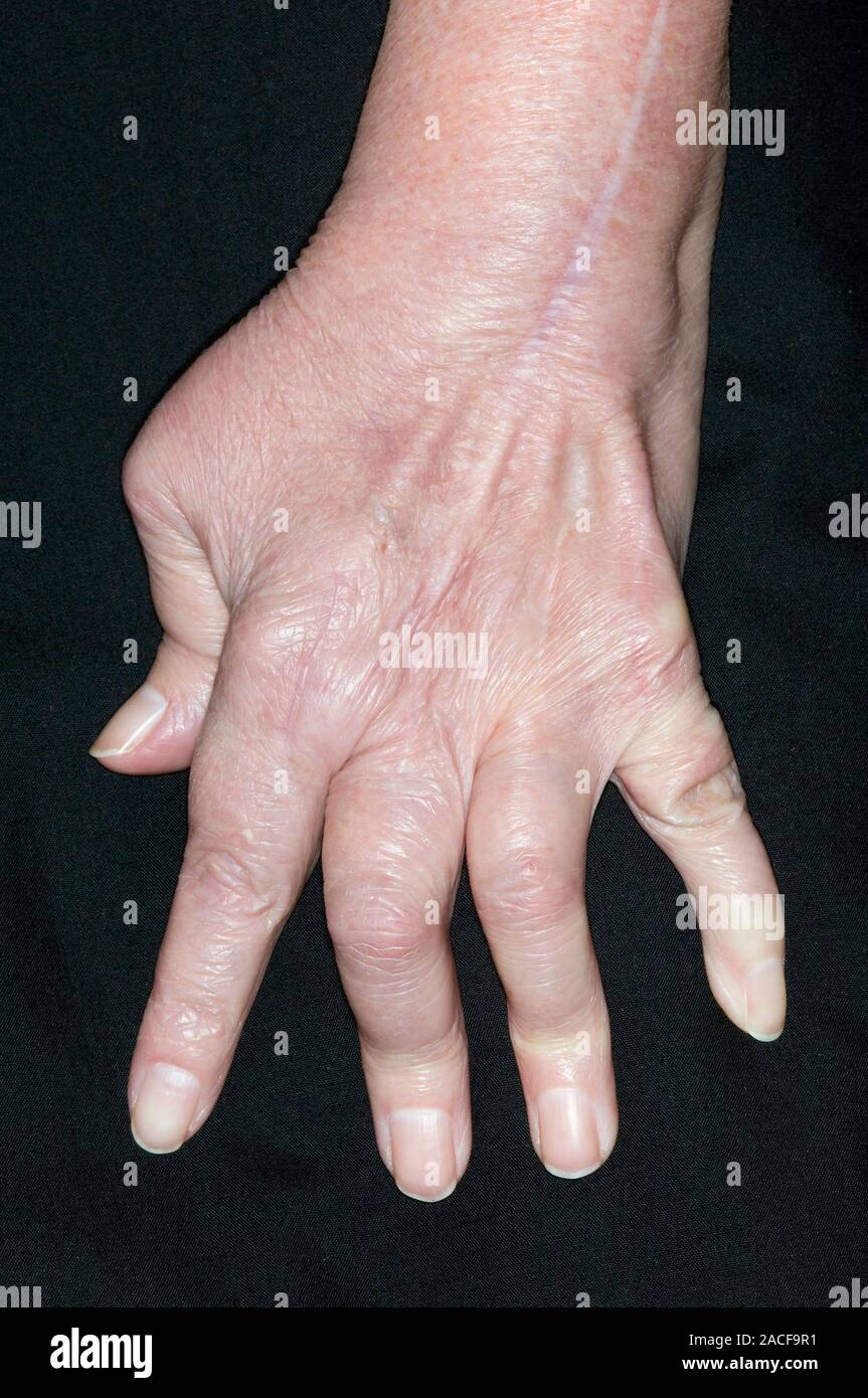 La polyarthrite rhumatoïde affectant la main d'une femme de 58 ans. La ...