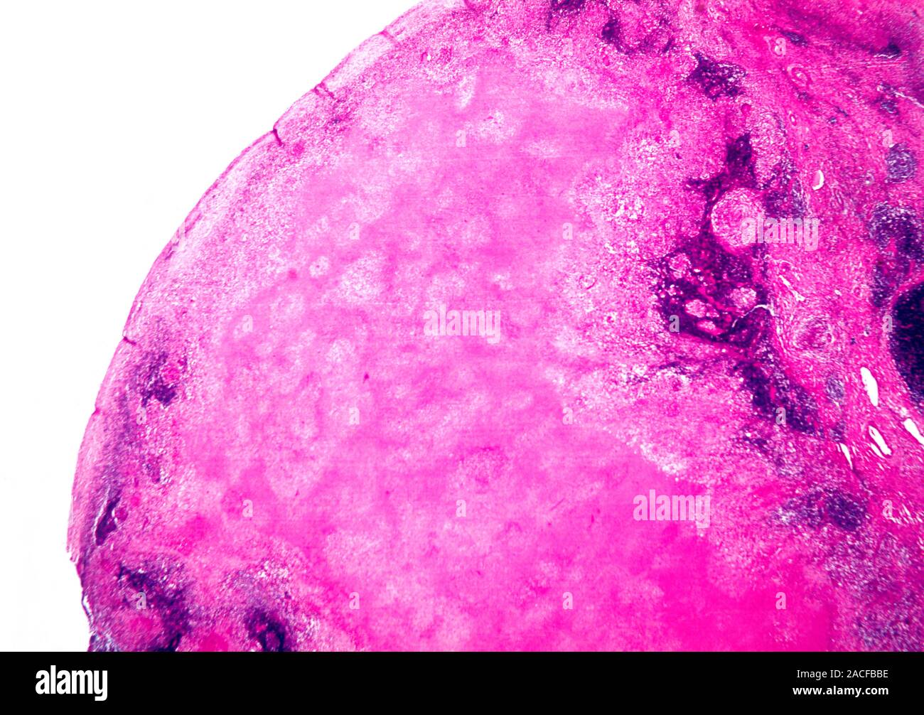 Ganglions tuberculeux. Micrograph Light d'un ganglion tuberculeux dans ...