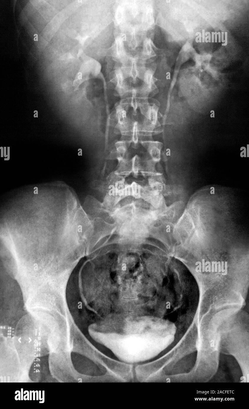 La colonne vertébrale et du bassin. X-ray frontale de la colonne ...