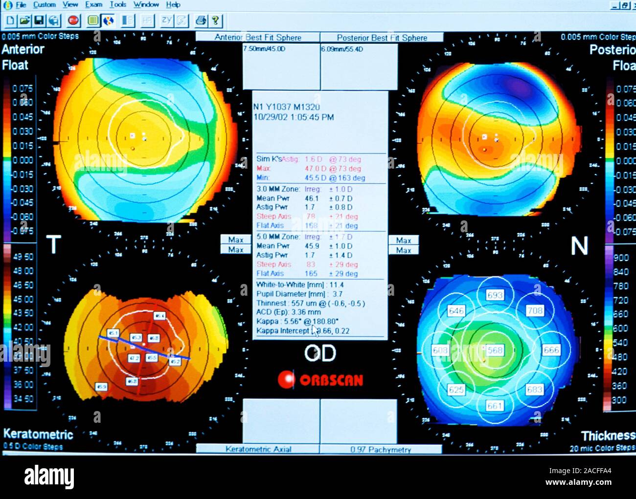 Cartographie de la cornée après la chirurgie oculaire au laser, capture ...
