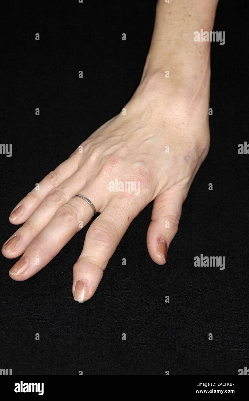 La polyarthrite rhumatoïde affectant la main d'une femme de 45 ans. La ...