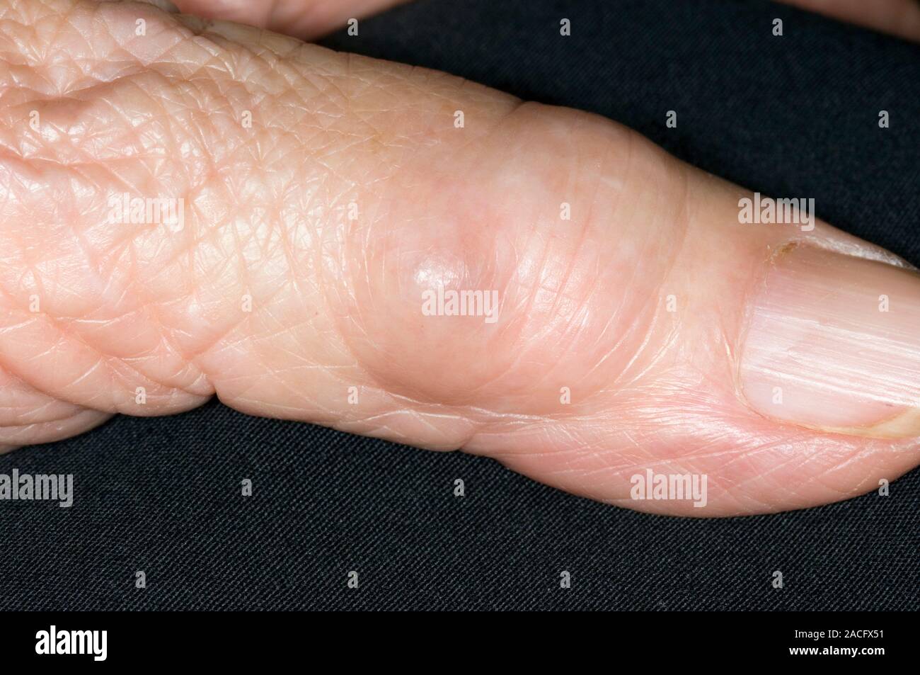 Kyste synovial sur le doigt d'un patient âgé. Le kyste est rempli de ...
