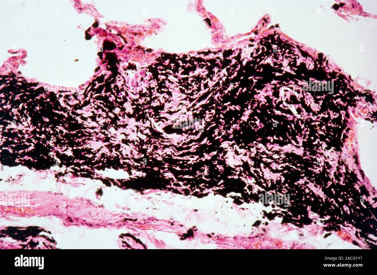 La fibrose pulmonaire. Microphotographie lumière d'une section par un ...