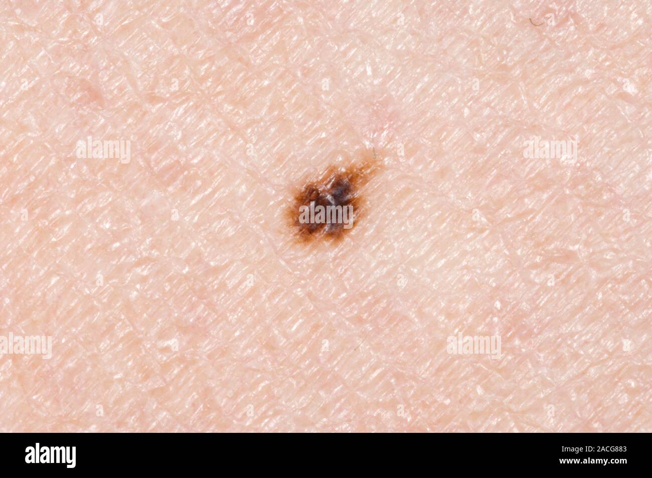 Close-up of a mole (naevus) sur la peau du tibia chez un patient adulte ...