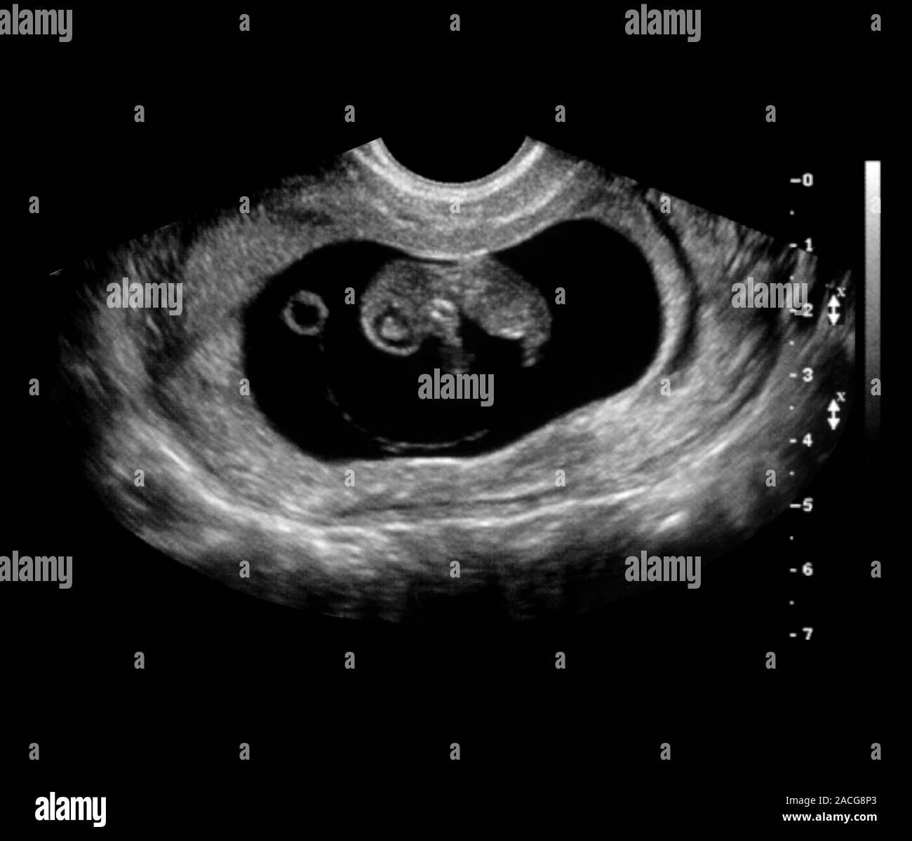 Échographie De Labdomen Dune Femme Enceinte Par Patient Montrant Une