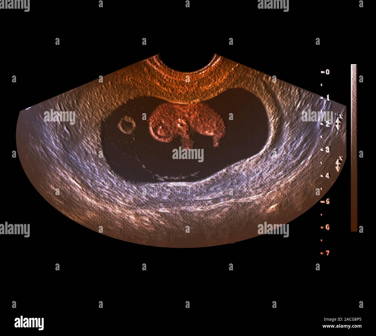 Échographie Couleur De Labdomen Dune Femme Enceinte Par Patient