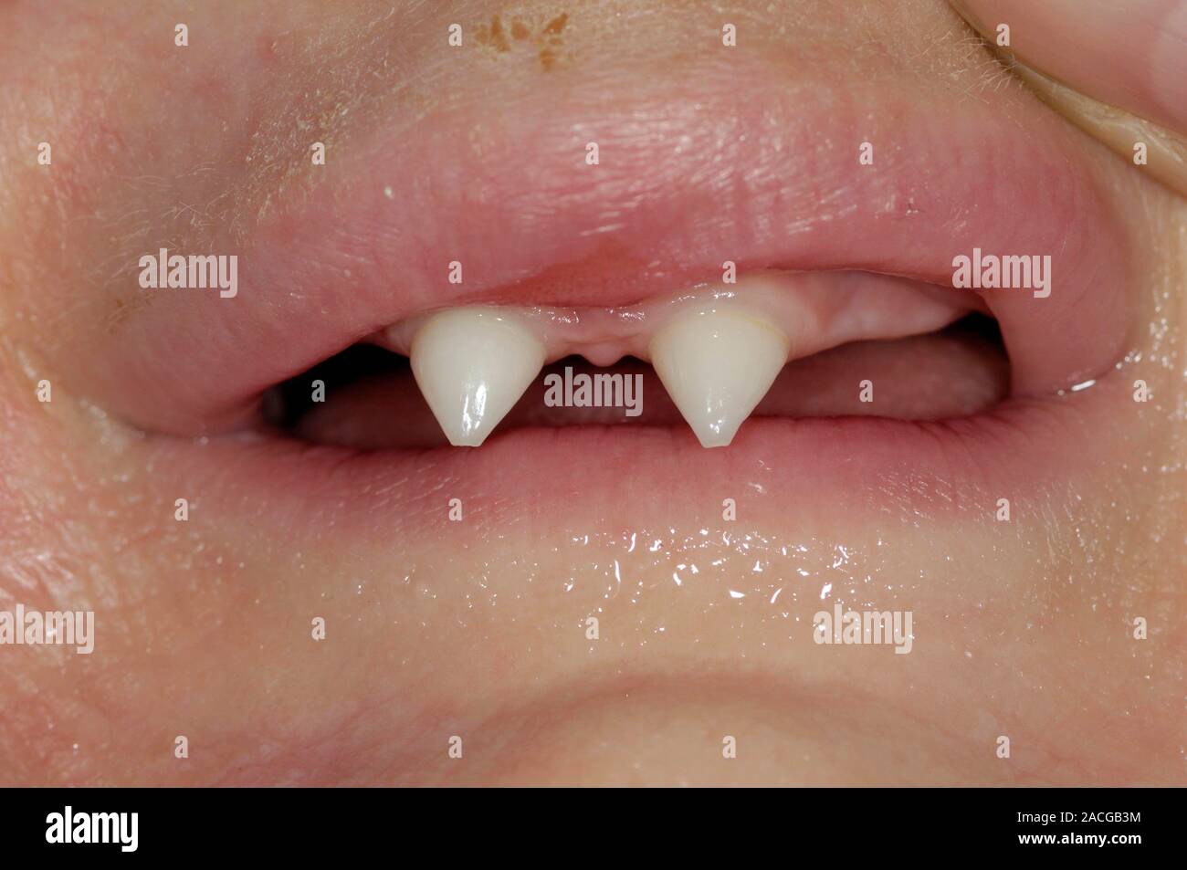 Anomalie des dents dans un 2 ans homme patient avec dysplasie ...