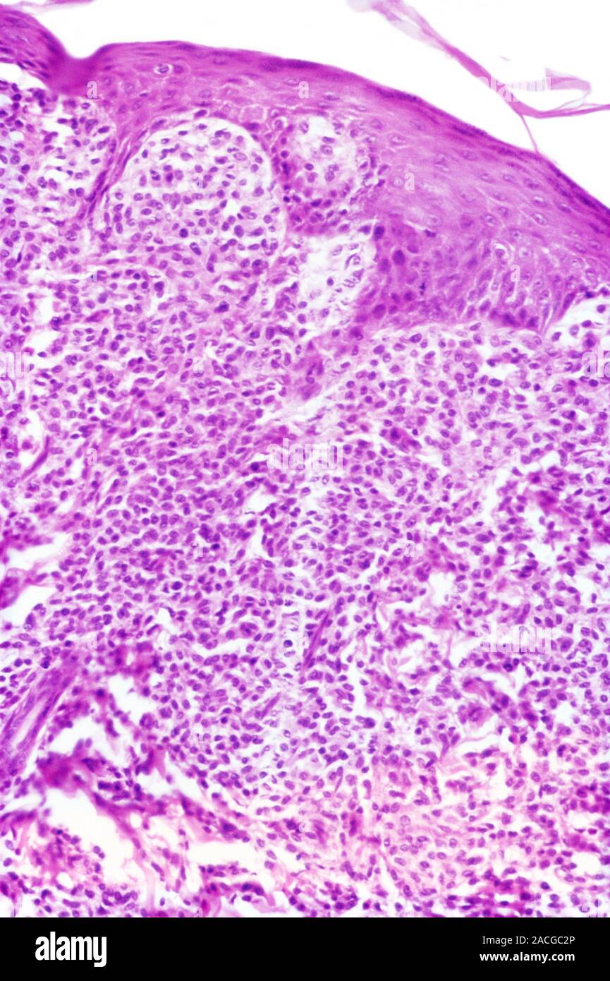 Le psoriasis. Microphotographie lumière d'une section au travers de la ...