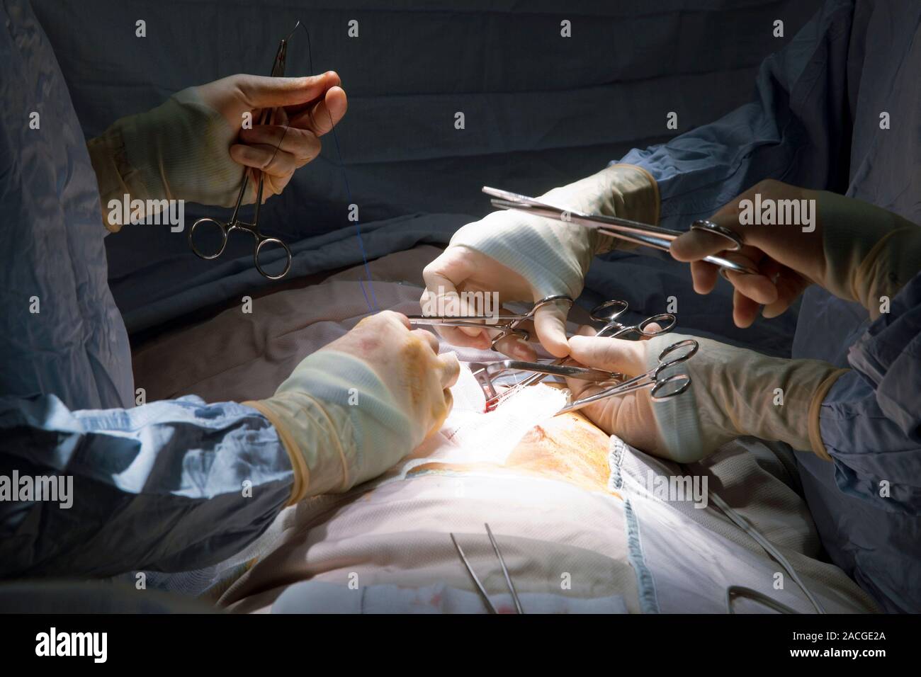 Hernie. Surgeons performing la chirurgie pour réparer une hernie ...