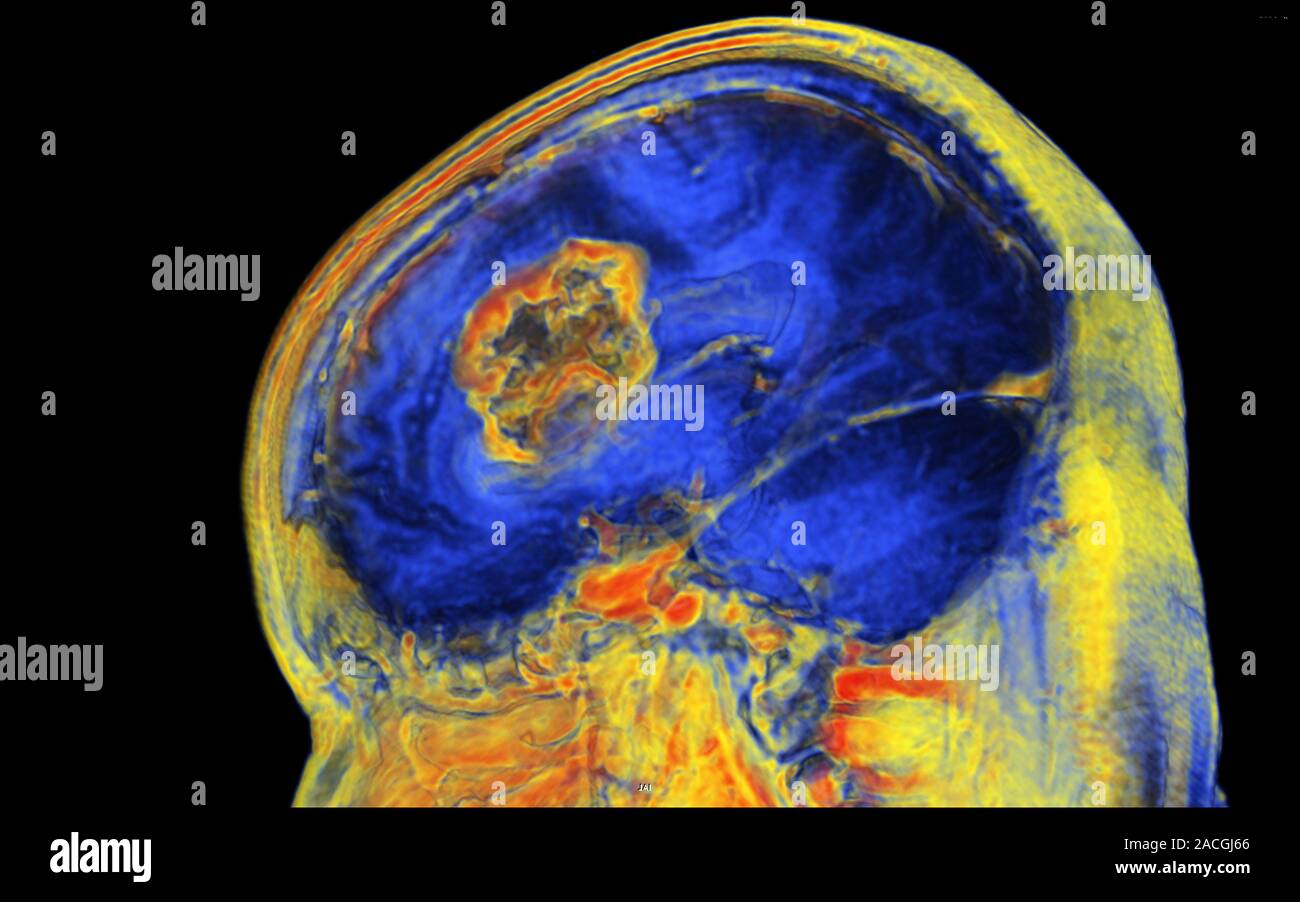 Tumeur au cerveau. Modèle à trois dimensions de couleur d'un homme chef, composé de nombreux l ...