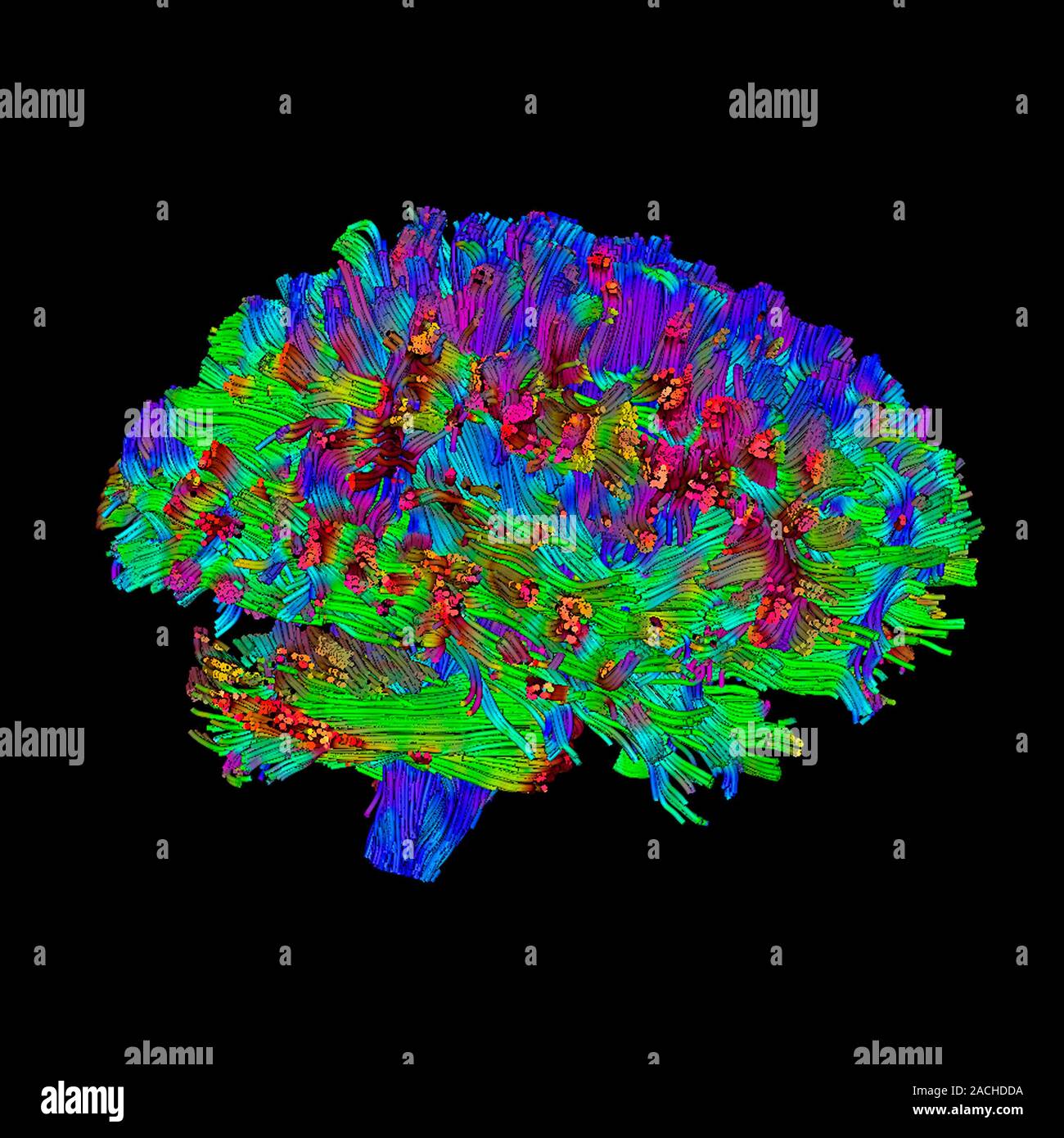 Tumeur au cerveau. 3D couleur l'imagerie du tenseur de diffusion (DTI) du cerveau d'un 29 ans ...