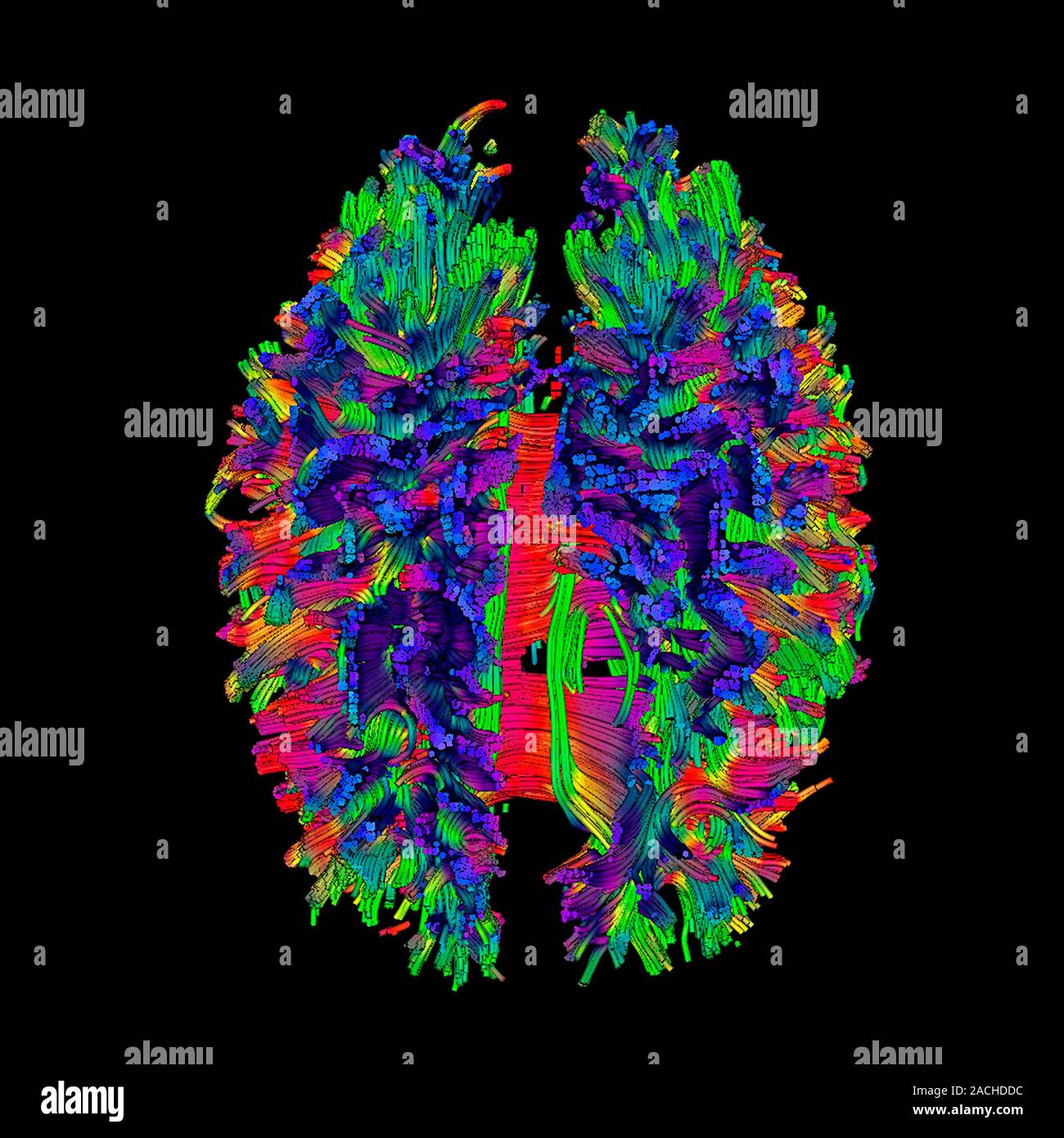 Tumeur au cerveau. 3D couleur l'imagerie du tenseur de diffusion (DTI) du cerveau d'un 29 ans ...