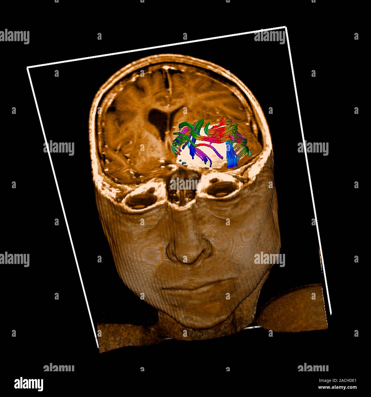 Tumeur au cerveau. 3D couleur l'imagerie du tenseur de diffusion (DTI) et l'imagerie par ...